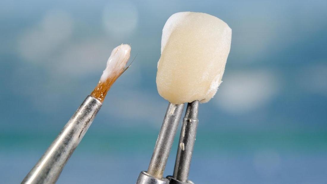 Dental Fillings Encinitas CA | Dental Crowns in Encinitas CA